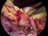 Laparoscopic Right Colectomy - Step III + IV • Video • MEDtube.net