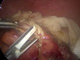 Laparoscopic Appendicectomy (Stapled) - Perforated Appendix • Video ...
