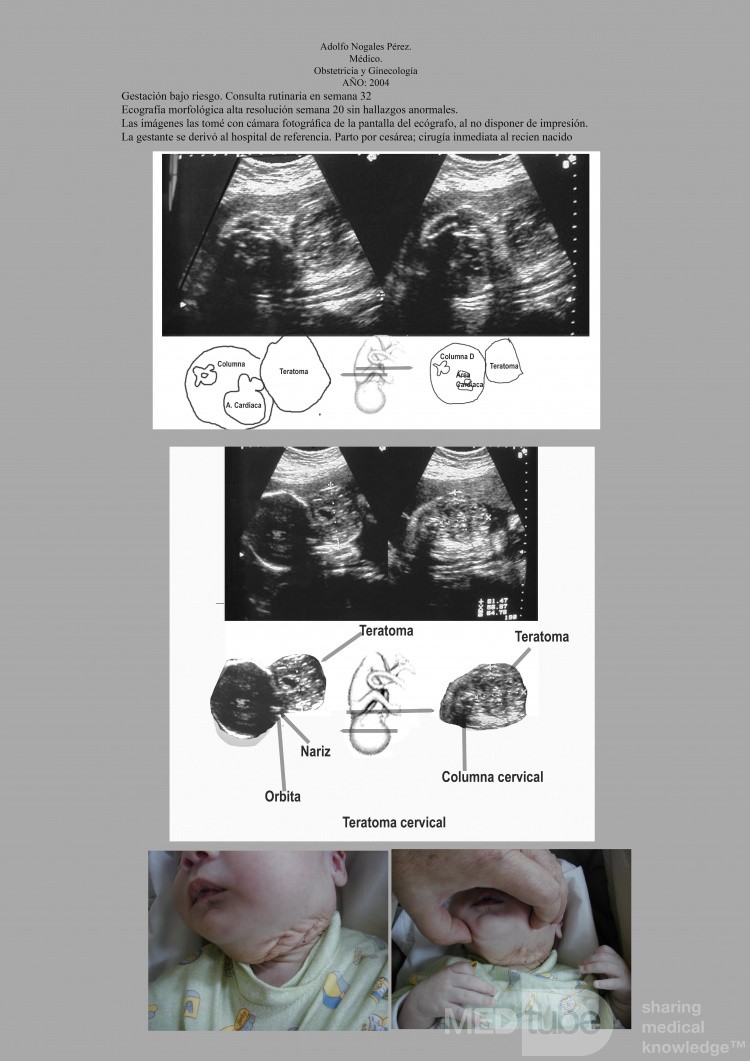 Fetal Cervical Teratoma Prenatal Ultrasound Diagnosis • Image • MEDtube.net
