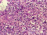 Non-Hodgkin's Lymphoma of the Colon (13 of 16) • Image • MEDtube.net
