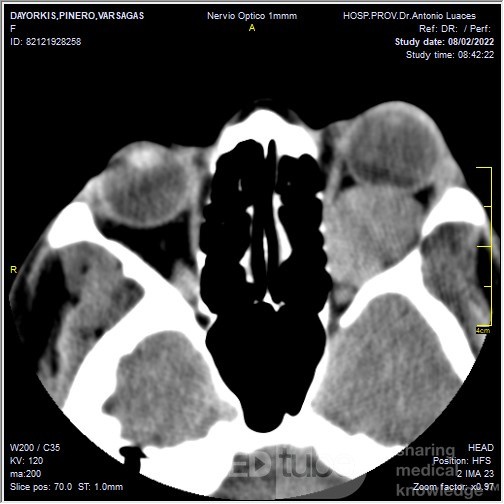 Total Resection of the Lesion Through a Lateral Fronto-Zygomatic Orbit ...