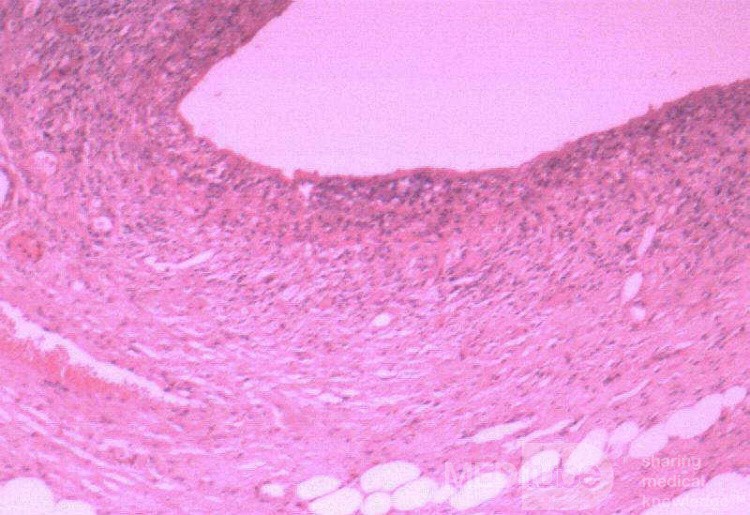 Multiple Rectal Ulcers (102 of 110) • Image • MEDtube.net