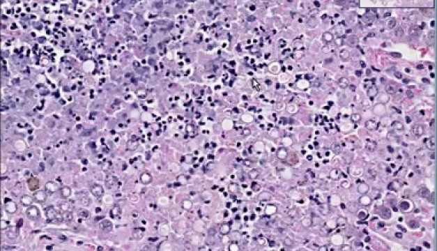 Blastomycosis Histology Blastomycosis | Dermatopathology