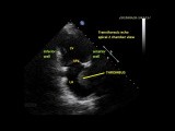 An Interesting Echocardiography Case Apical 2 Chamber View • Video ...