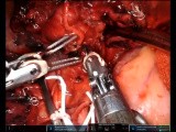 Uniportal Fully Robotic (URATS) Right Upper Bronchial Sleeve Lobectomy ...