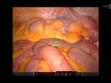 Robotic Sigmoid Colon Resection for Recurrent Diverticulitis • Video ...