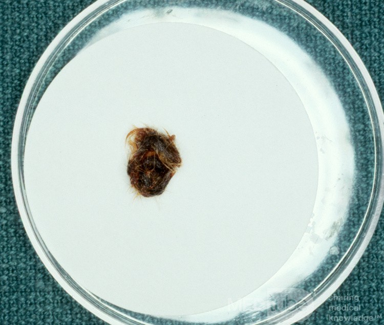 Brown Cerumen before Application of an Aqueous Solution • Image ...