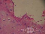 Candida Esophagitis - Endoscopy (5 of 5) • Image • MEDtube.net