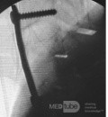 Cloward's Anterior Approach for AO Spine Type C Cervical Fracture with ...