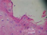 Candida Esophagitis - Endoscopy (4 of 5) • Image • MEDtube.net