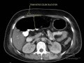 Multiple Rectal Ulcers (43 of 110) • Image • MEDtube.net