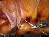 Robotic TAPP Groin Hernia Repair Basics • Video • MEDtube.net
