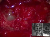 Adhesiolysis L2/L3/L4 + Removal of Large Disc Herniations: L2/L3/4 TLIF ...