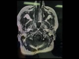 Left Middle Fossa Approach for a Recurrent Cavernous Meningeoma • Video ...