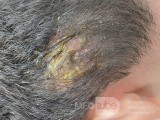 Kerion (Tinea Capitis Infection) • Image • MEDtube.net