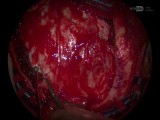 Right Sided Craniotomy and Resection of Posterior Temporal Sylvian AVM ...