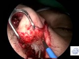 Lateral Rhinotomy Surgery • Video • MEDtube.net