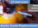 Aortic Valve Size 31mm • Video • MEDtube.net