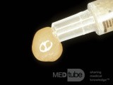 Thick Mucoid Fluid [middle ear aspirate] • Image • MEDtube.net
