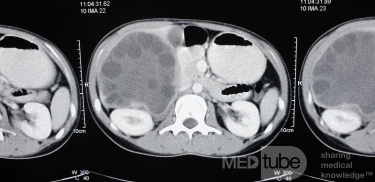 CT Liver Hydatid Cyst • Image • MEDtube.net