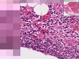Bacterial Pericarditis • Video • MEDtube.net