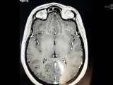 Extended Transnasal Transsphenoidal Transpterygoid Approach for ...