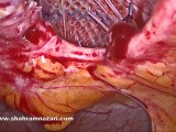 Laparoscopic Ventral Incisional Hernia Repair Using Intraperitoneal ...