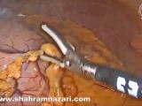 Laparoscopic Resection of Gastrointestinal Stromal Tumor (GIST) • Video ...