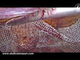 Laparoscopic Inguinal Hernia Tension Free Darn Mesh Repair • Video ...