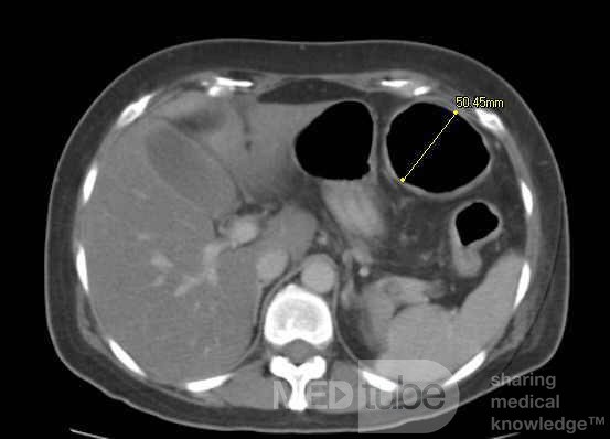 Multiple Rectal Ulcers (39 of 110) • Image • MEDtube.net