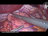 3 Stitch Modification of the Dor Fundoplication • Video • MEDtube.net