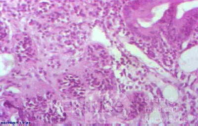 Duodenal Carcinoid (4 of 4) • Image • MEDtube.net
