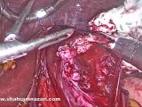 Laparoscopic Heller Myotomy for Extreme Megaesophagus an Alternative to ...