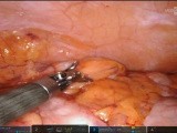 Robotic Appendectomy for Tumeur of Appendix (LAMN) • Video • MEDtube.net