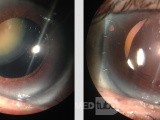 Dislocated Hard Cataract • Image • MEDtube.net