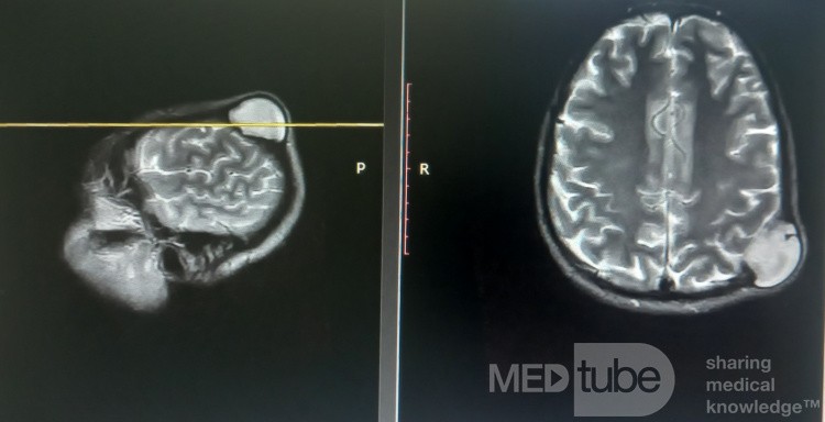 Epicranial Tumor Injury • Image • MEDtube.net