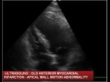 Old Anterior Wall Myocardial Infarction -apical Wall Motion Abnormality ...