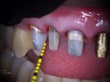 Saving a Smile: How We Rescued Damaged Teeth Against All Odds • Video ...