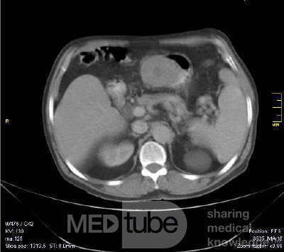 Gastrointestinal Stromal tumor (GIST) (11 of 13) • Image • MEDtube.net