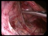 Laparoscopic Ileo-cecal Resection the Total Retro-mesenteric Approach ...