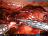 Robotic Appendectomy for Retrocaecal Appendicitis with Abcess • Video ...