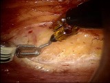 Robotic Inguinal Lymph Node Dissection by Lateral Approach • Video ...