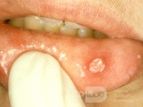 Apthous Ulcer • Image • MEDtube.net