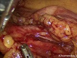 Advanced Sigmoid Colon Cancer Surgical Treatment • Video • MEDtube.net