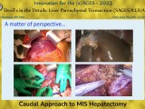 Caudal Approach to MIS Hepatectomy • Video • MEDtube.net