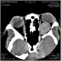 Total Resection of the Lesion Through a Lateral Fronto-Zygomatic Orbit ...