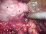 Left pyeloureteral stenosis. Laparoscopic pyeloplasty. • Video ...