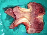 Endoscopy of Scirrhous Gastric Carcinoma involving the entire Fundus ...