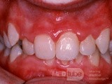 Gingivitis • Image • MEDtube.net