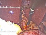 Antegrade Common Bile Duct (CBD) Stenting After Laparoscopic CBD ...